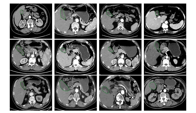 A distance function based cascaded neural network for accurate polyps ...