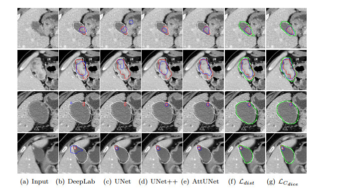 A distance function based cascaded neural network for accurate polyps segmentation and ...