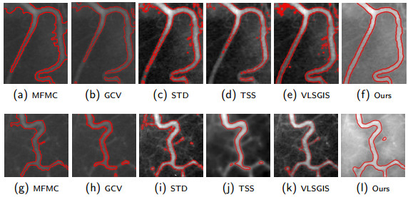 A variational image segmentation model with intensity correction in the presence of high level ...