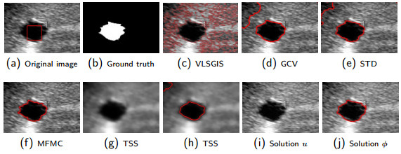 A variational image segmentation model with intensity correction in the presence of high level ...